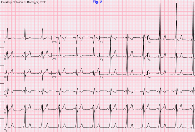 Delta wave | ECG Guru - Instructor Resources